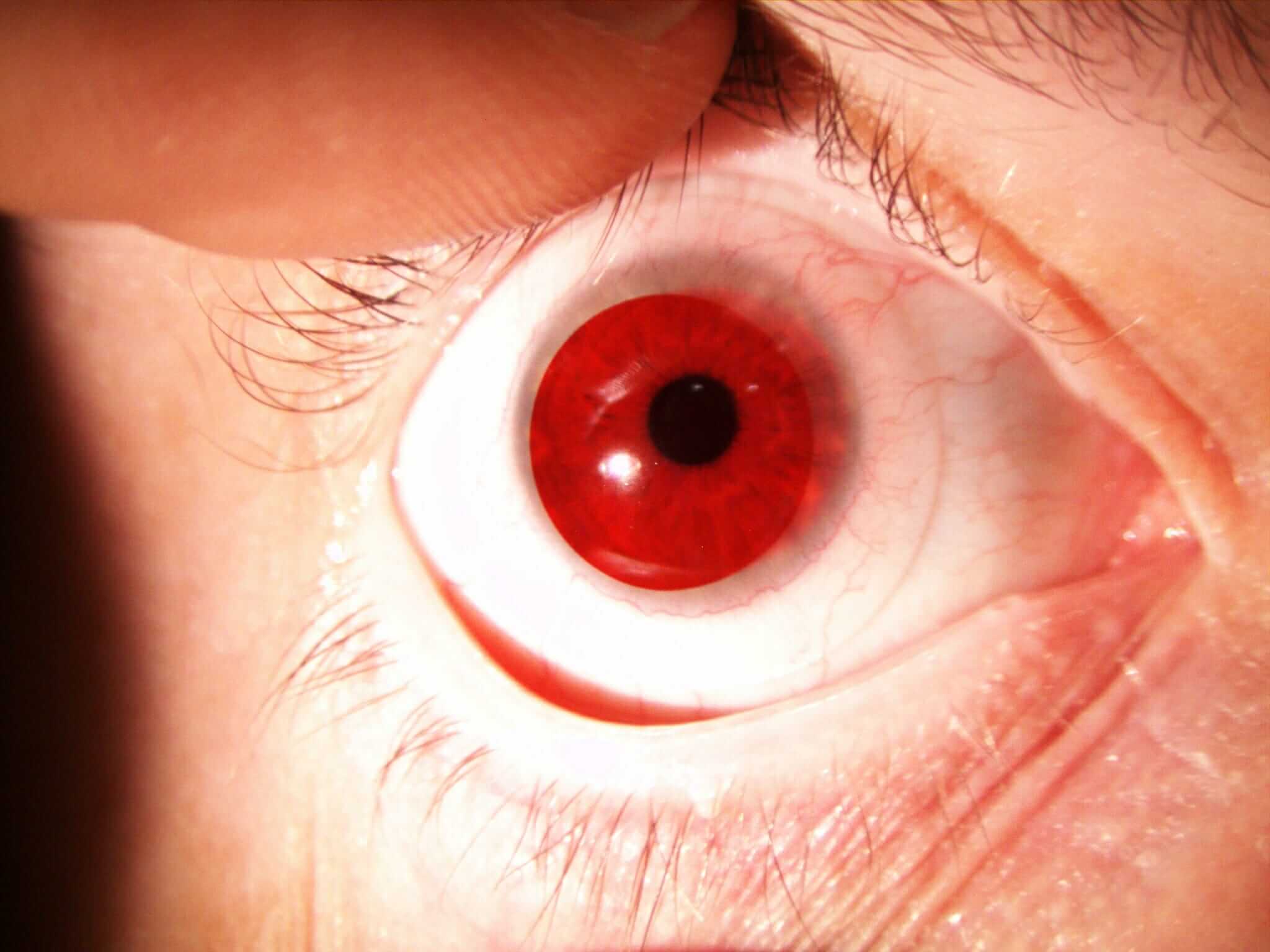 Achromatopsia | Lenses to Improve Day-Time Light Sensitivity | EYETECH