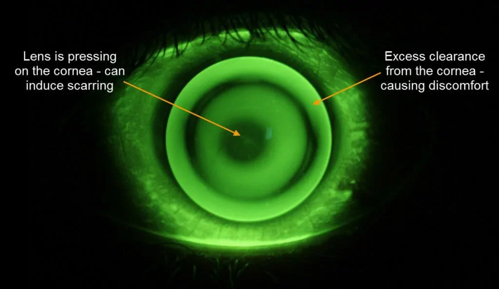 Scleral Contact Lenses Keratoconus