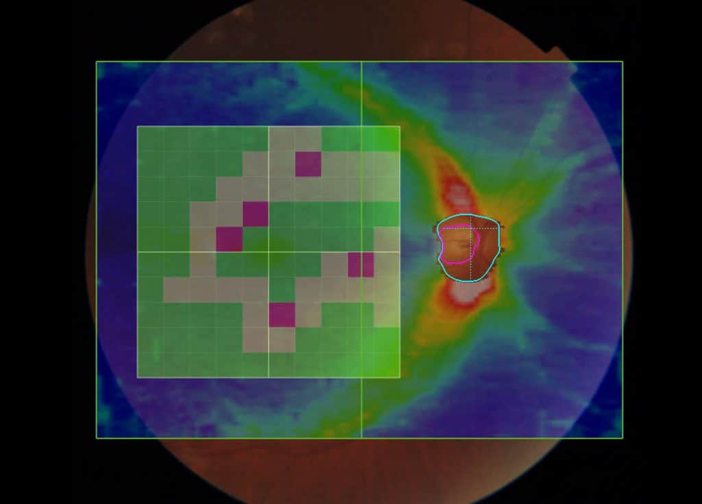 Glaucoma Consultations – EYETECH